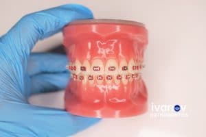 Power Chain Braces for a Better Smile | Ivanov Orthodontics