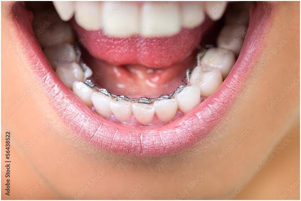 Behind Teeth Braces Miami | Braces on Back of Teeth