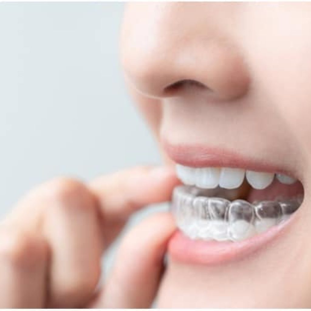 Invisalign Attachments: Understanding Their Purpose and Care