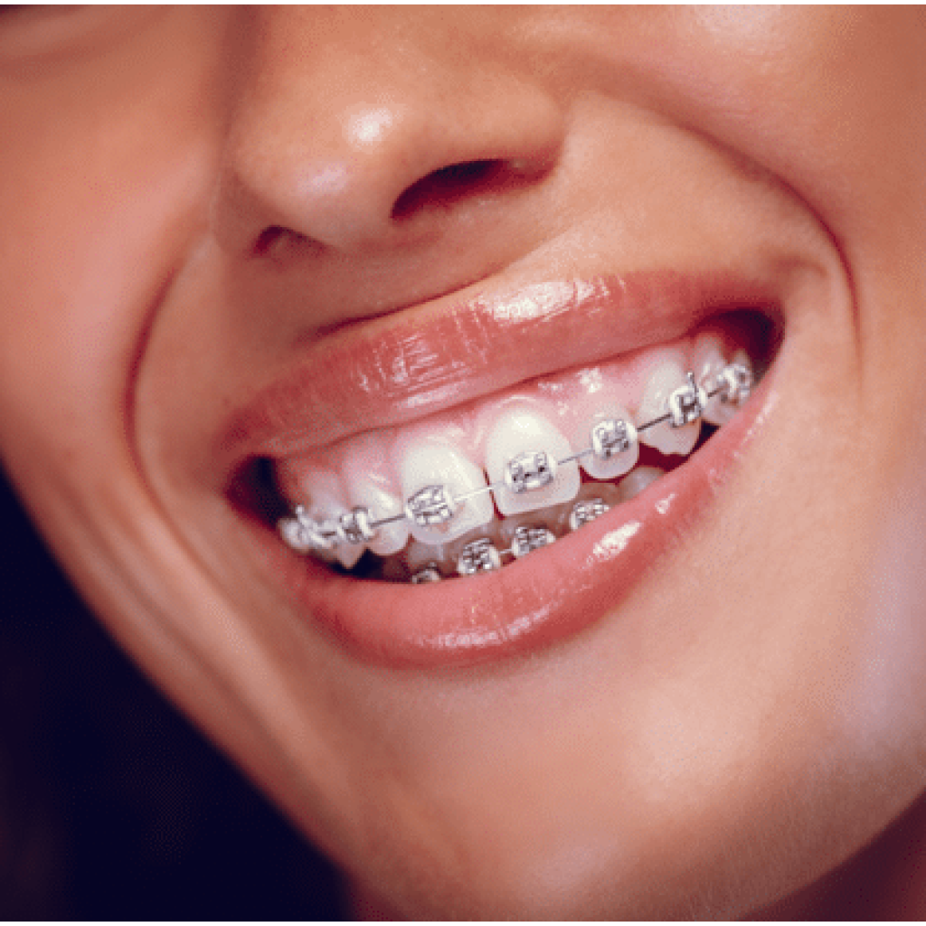 Understanding and Addressing Teeth Stained From Braces