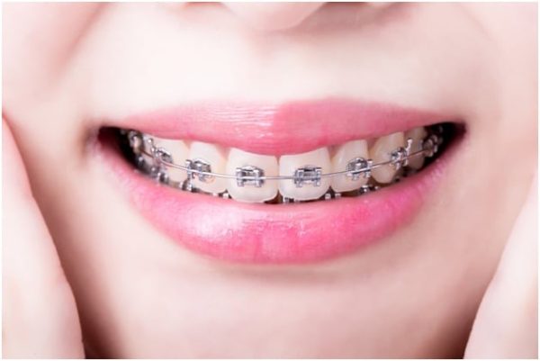 Best Braces Glue: What Orthodontists Use & Why It Matters