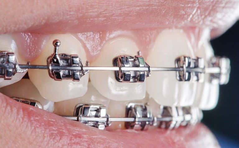 Triangle Rubber Bands for Braces: Usage & Benefits in Miami