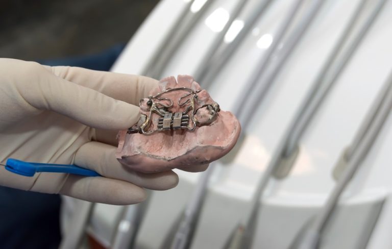 Banded vs. Bonded Expanders: Understanding RPE and RME