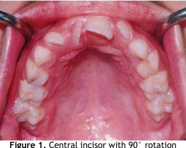 Rotated Tooth: Causes, Effects & Orthodontic Treatments