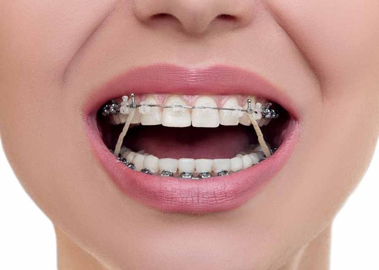Understanding Rubber Bands in Braces: Types & Functions